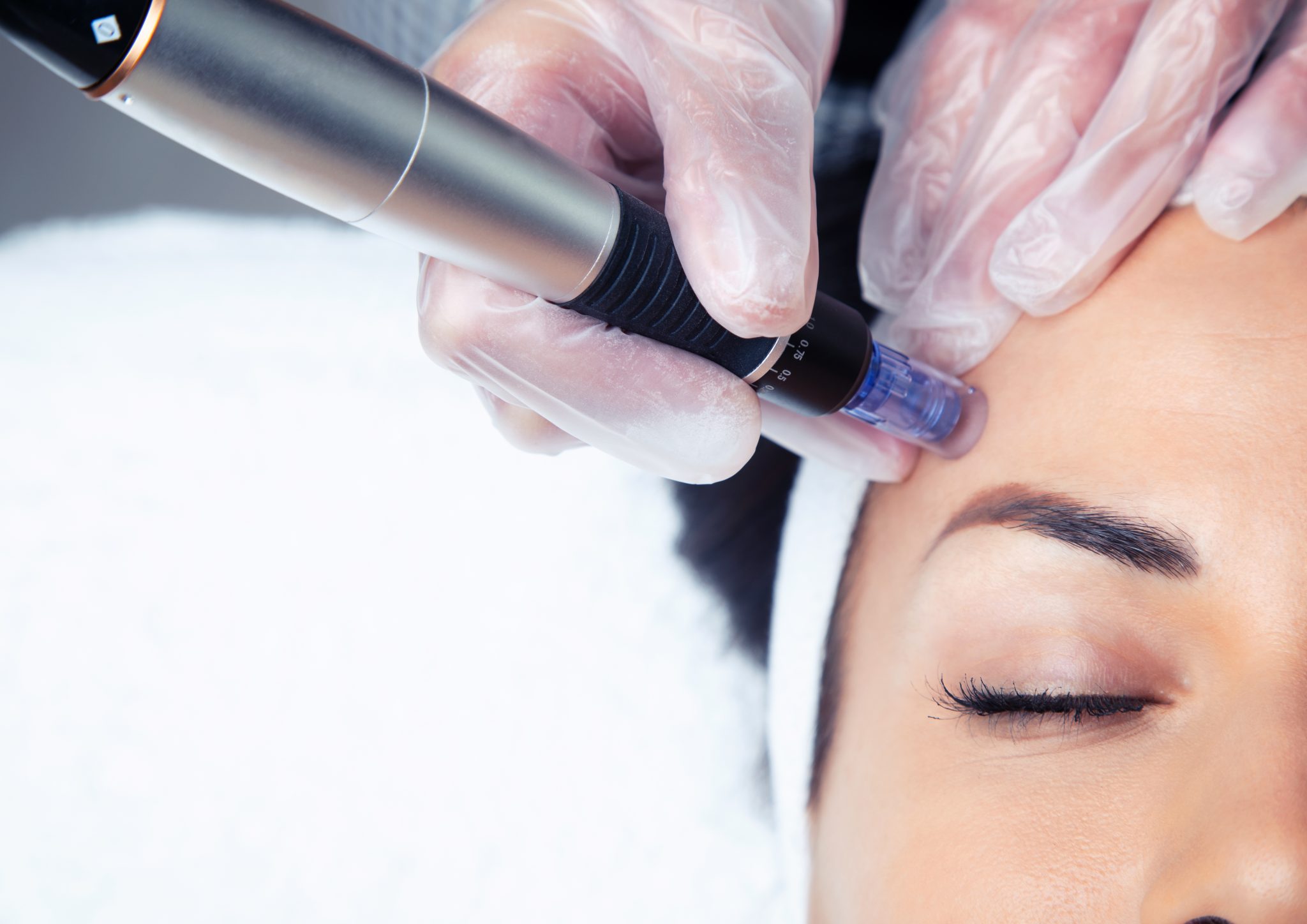 Microneedling – Salon zdravja in lepote Klara